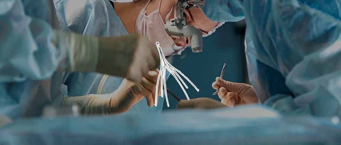 Argon IVC Filter Class Action Lawsuit | Free Case Evaluation