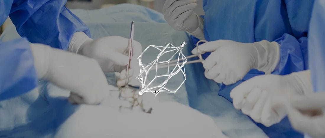 Optease IVC Filter Lawsuit | Free Case Evaluation